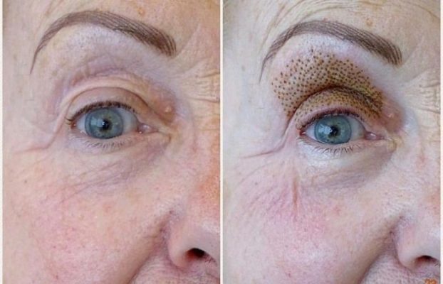 Fibroblast Skin Tightening - removing excess skin volume